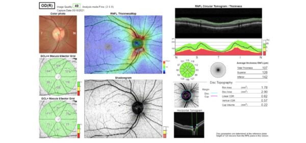 Eye OCT Scans & Diagnosis, Shrewsbury