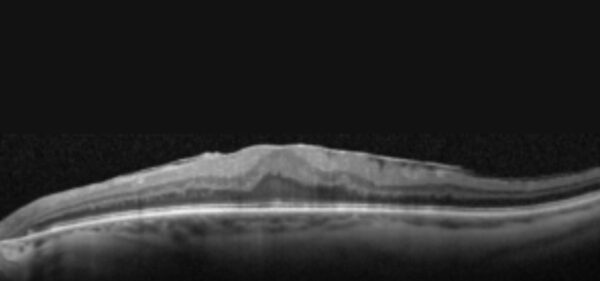 Eye OCT Scans & Diagnosis, Shrewsbury